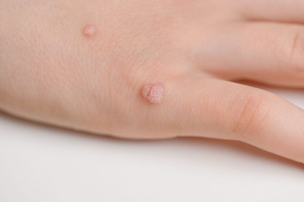 Negii (veruci): simptome, cauze și tratament – Tot ce trebuie să știi